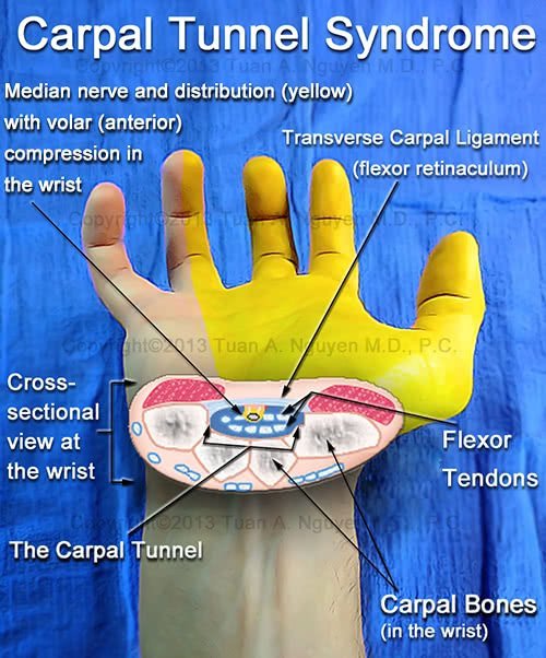 Carpal Tunnel Test & Non-Invasive Care Options