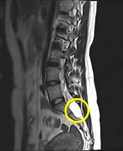 Tarlov Cyst Or Perineural Cyst | Learn All You Need to Know