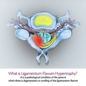 Facet Hypertrophy Treatment | Without Surgery Or Injections