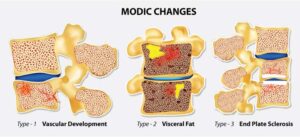 Modic Type I Changes and Your Spine’s Health